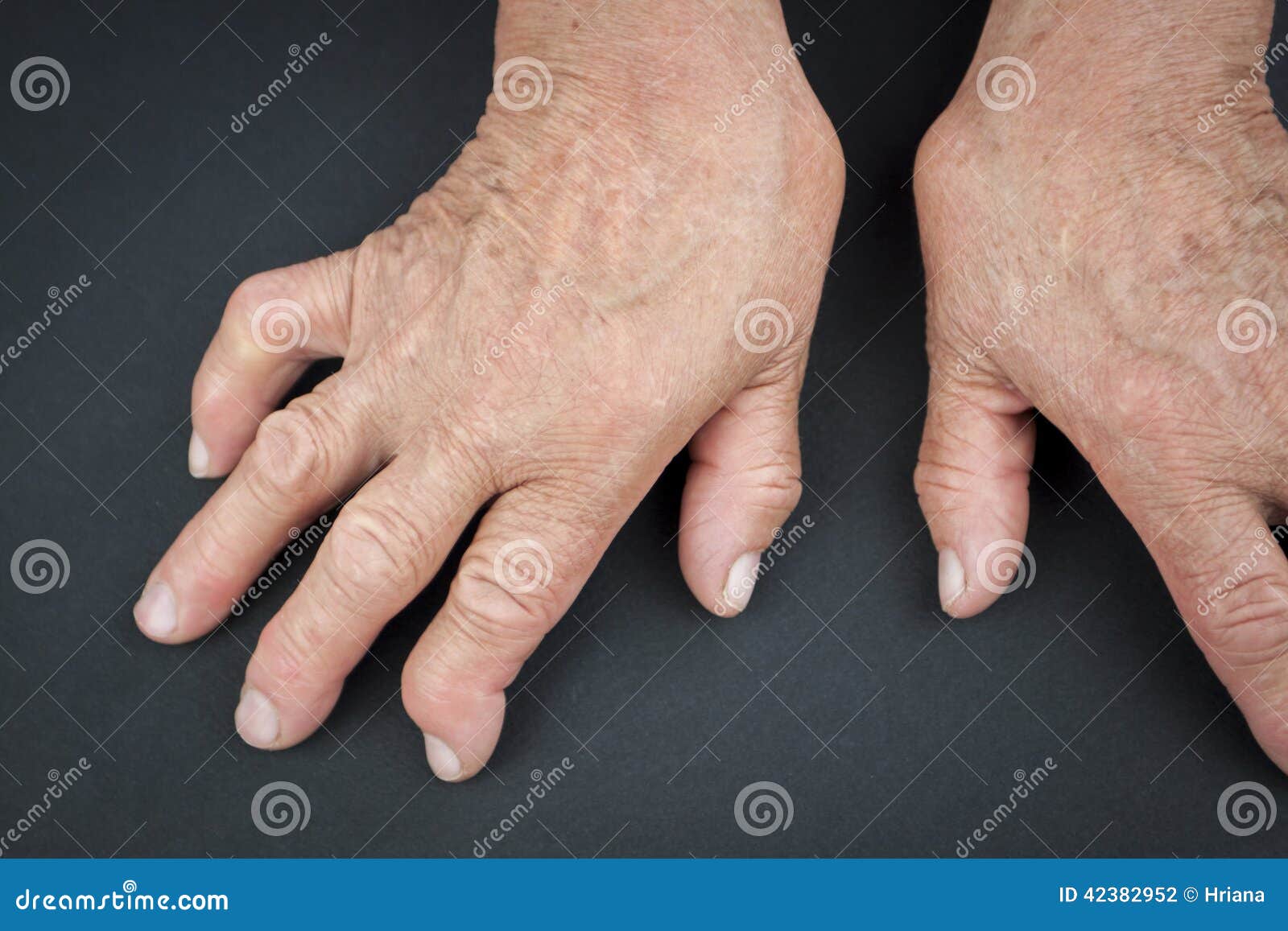 Mani di artrite reumatoide fotografia stock. Immagine di barrette ...