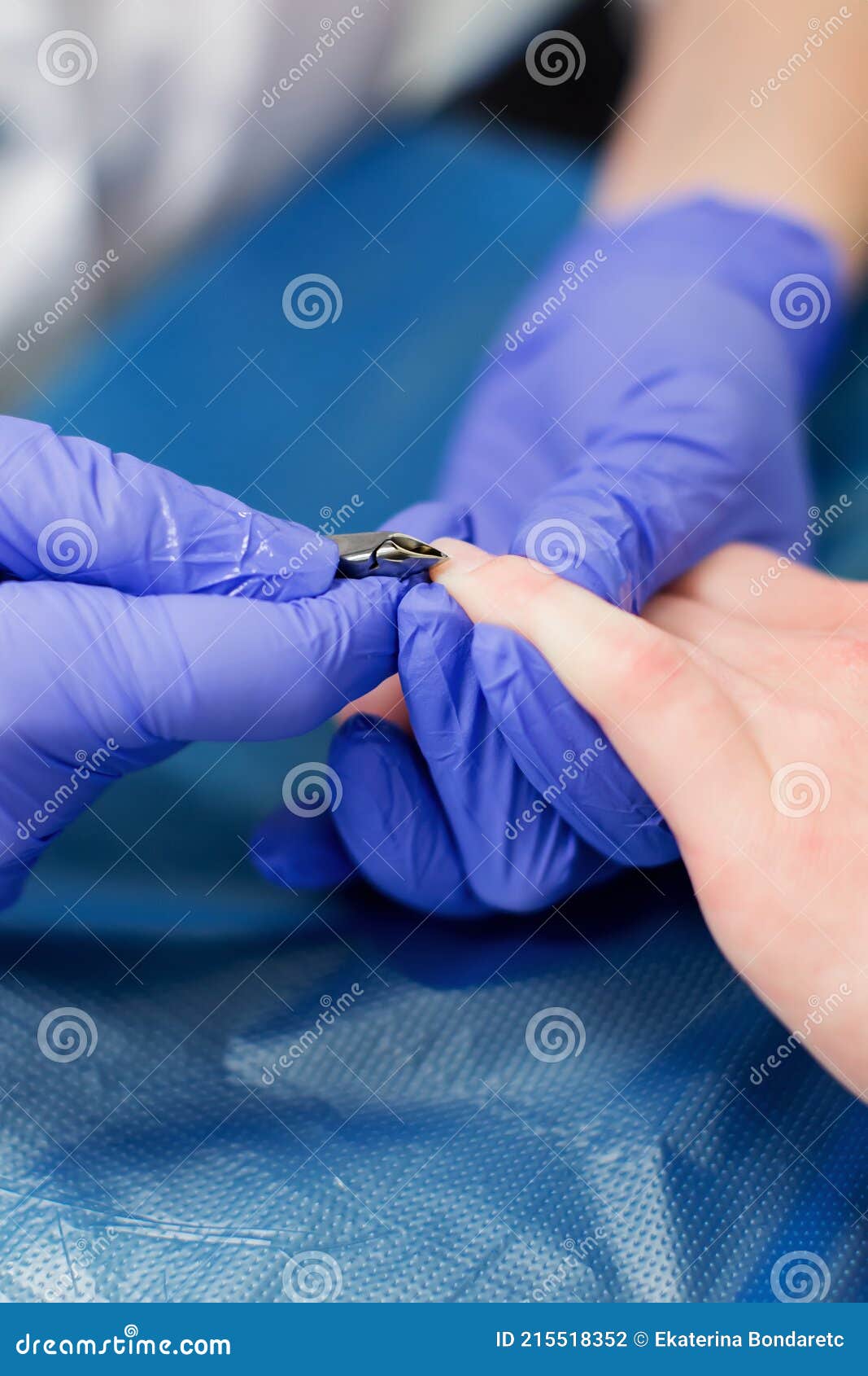 Burrs On The Finger. Inflammation And Abscess. Royalty-Free Stock ...