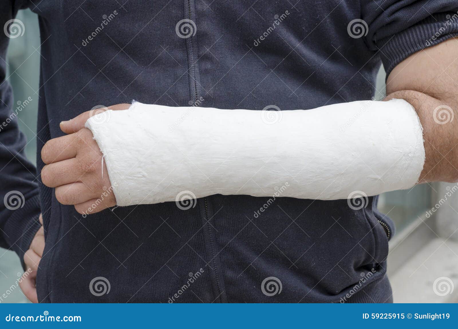 Mann Mit Seinem Gebrochenen Arm Arm in Der Form Stockbild - Bild von ...