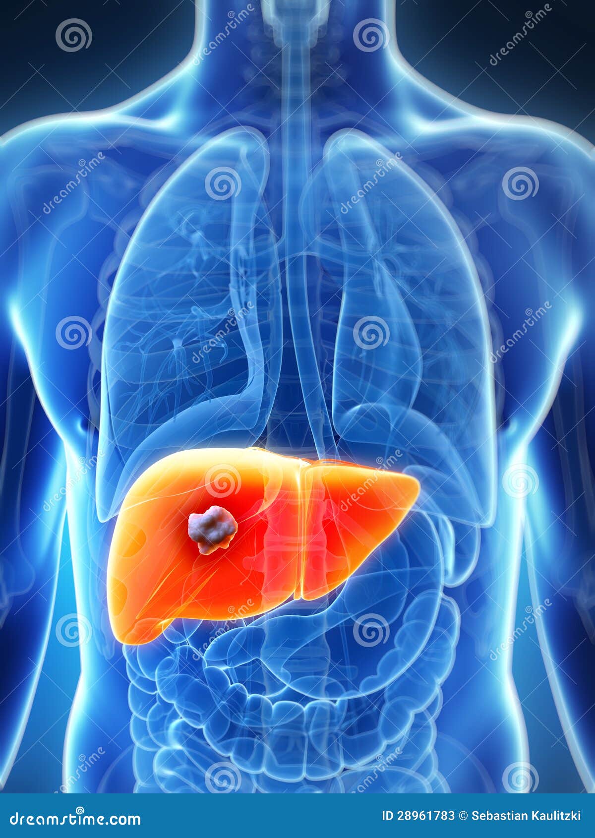 Mannelijke lever - kanker stock illustratie. Illustration of abces ...