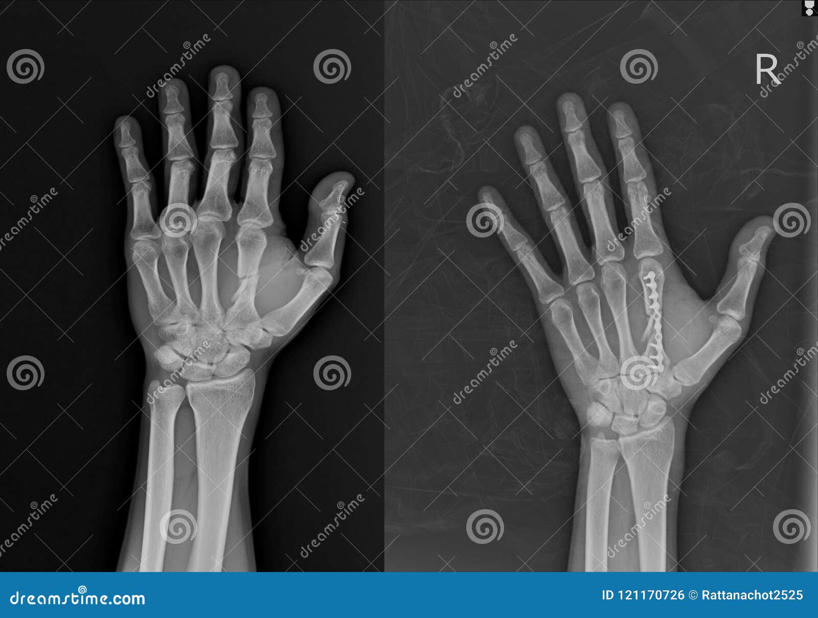 Mano AP De La Radiografía, OBLICUA: Mediados De Eje Rt De La Fractura ... Mano AP De La Radiografía, OBLICUA: Mediados De Eje Rt De La Fractura ...