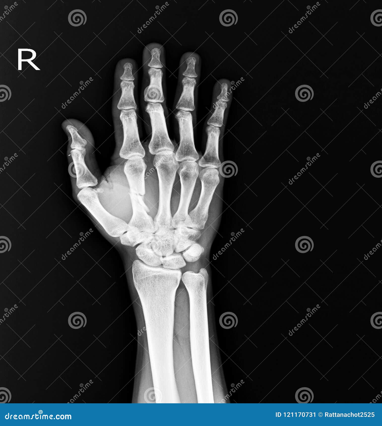 Mano AP De La Radiografía, OBLICUA: Mediados De Eje Rt De La Fractura ... Mano AP De La Radiografía, OBLICUA: Mediados De Eje Rt De La Fractura ...