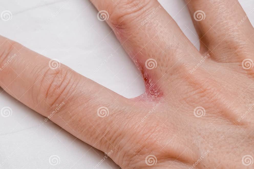 Mano Con Dermatitis Interdigital Eccema Disidrotico a Mano Foto de ...