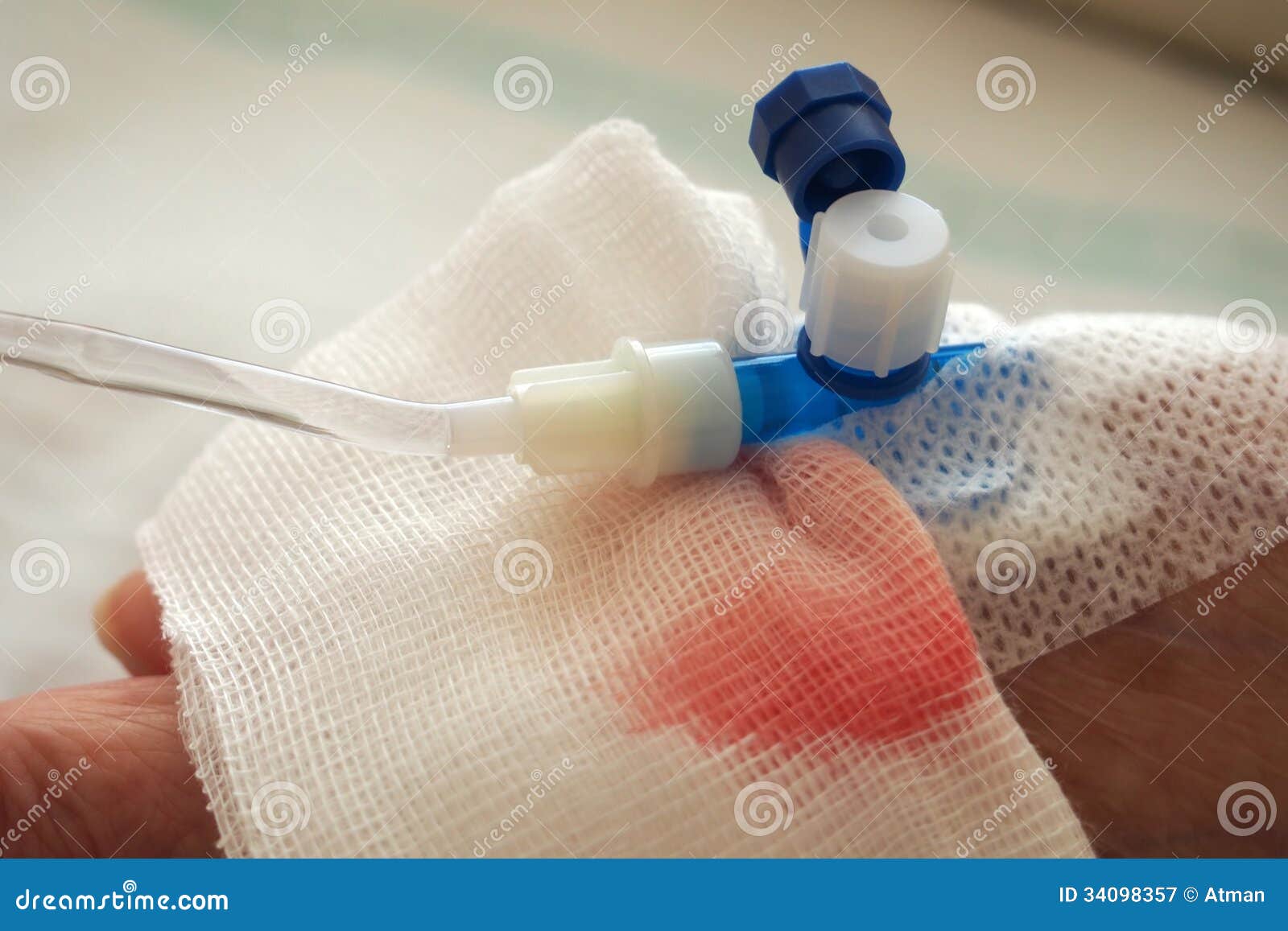 Mano Con El Catéter En Vena Imagen de archivo - Imagen de vena ...