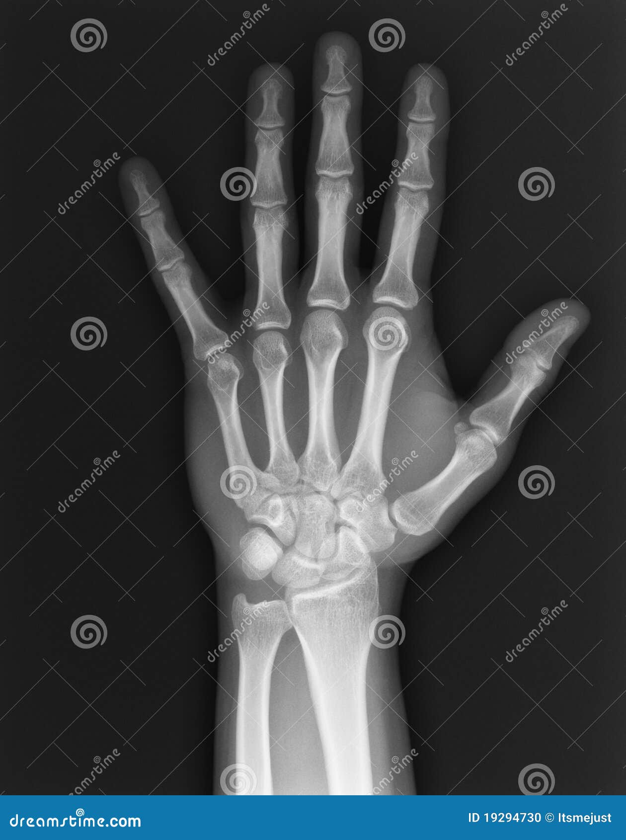 Mano dei raggi X fotografia stock. Immagine di radiologia - 19294730