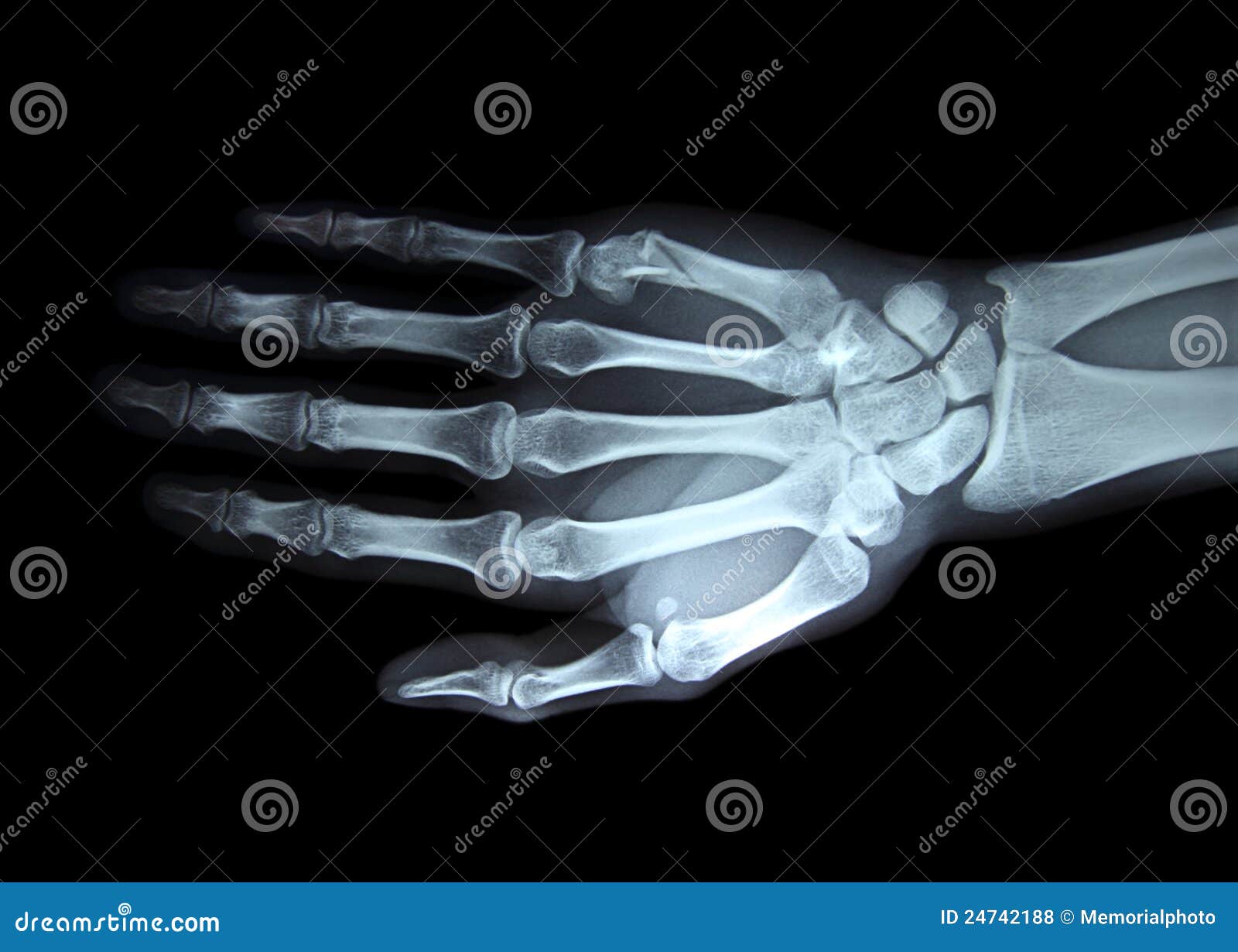 Mano destra dei raggi X fotografia stock. Immagine di ortopedia - 24742188