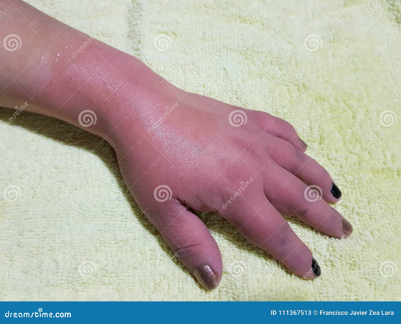 Mano hinchada de la mujer imagen de archivo. Imagen de piel - 111367513