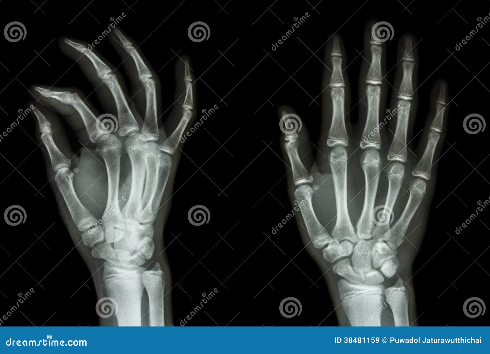 Mano Normal De Los Seres Humanos Imagen de archivo - Imagen de negro ...