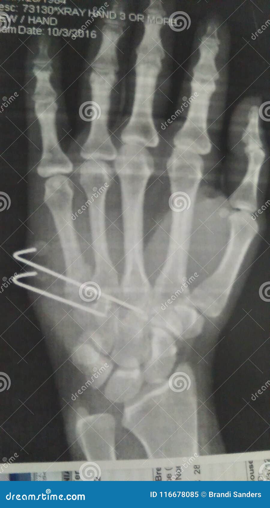 Mano quebrada imagen de archivo. Imagen de contactos - 116678085