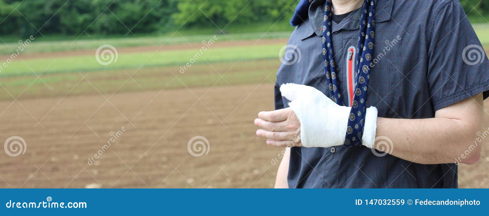 Mano quebrada de un hombre imagen de archivo. Imagen de hospitalizado ...