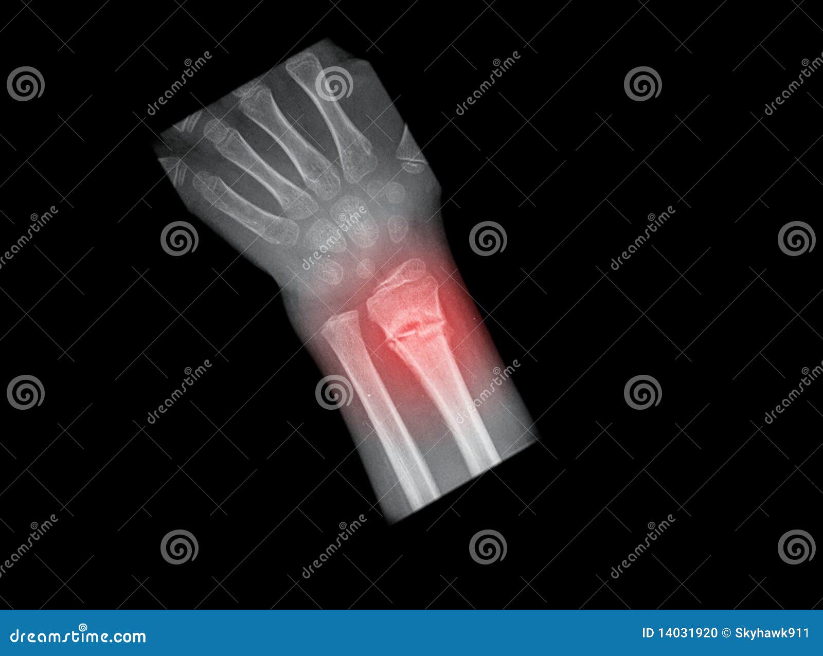 Mano rota Painfull foto de archivo. Imagen de ciencia - 14031920