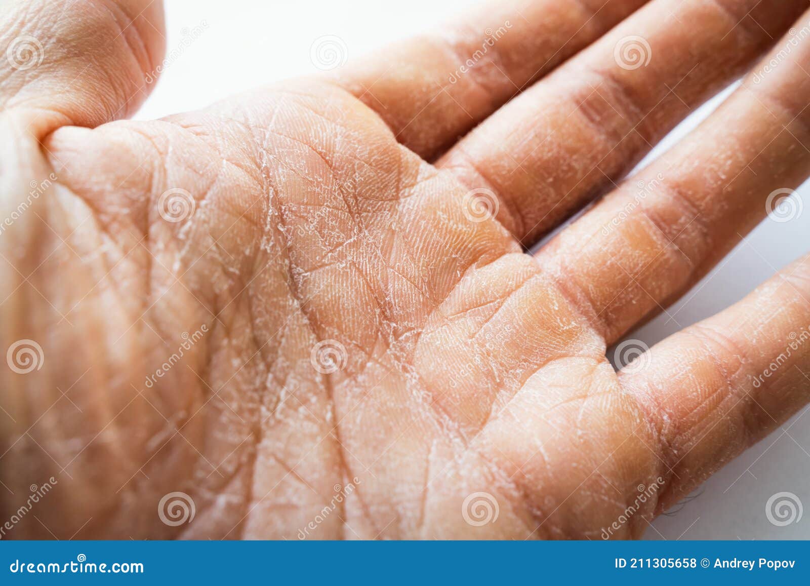 Mano seca foto de archivo. Imagen de agrietado, rojo - 211305658