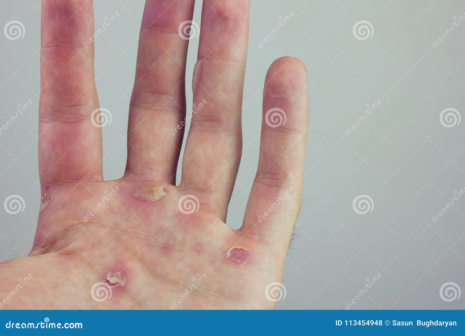 Manos Con La Ampolla Y El Callo Foto de archivo - Imagen de viejo ...