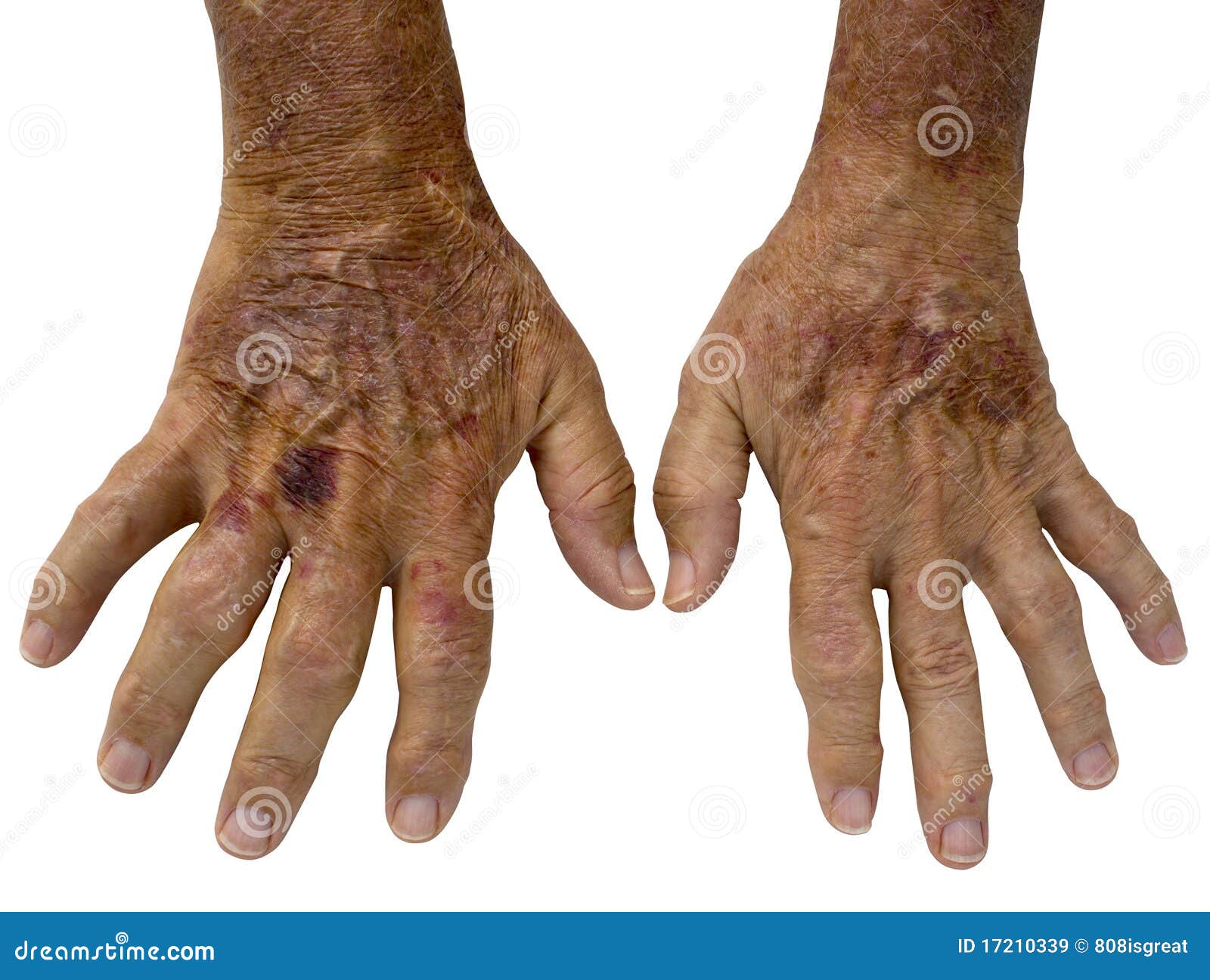 Manos Mayores Con Artritis Reumatoide Imagen de archivo - Imagen de ...