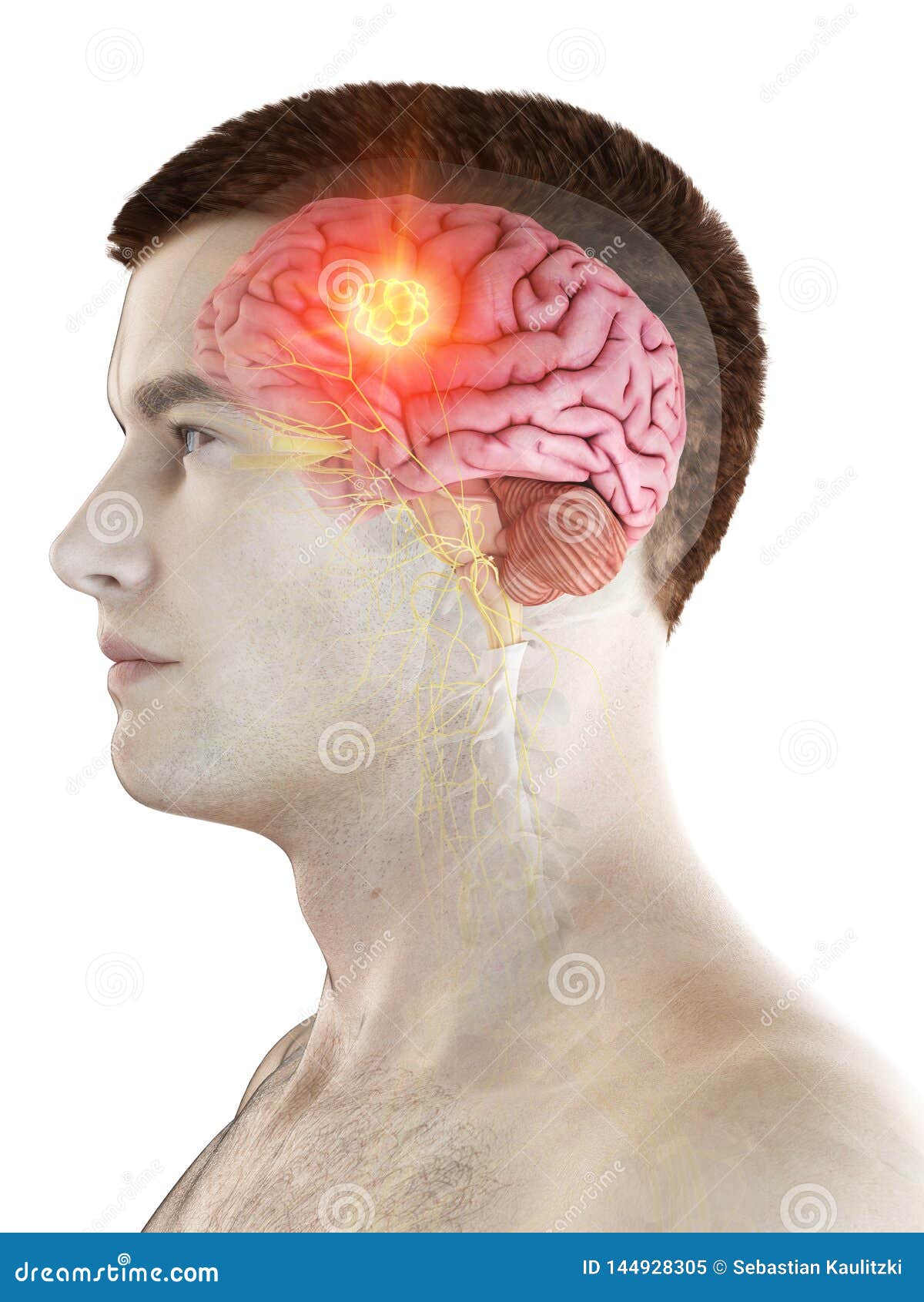 A mans brain tumor stock illustration. Illustration of mans - 144928305