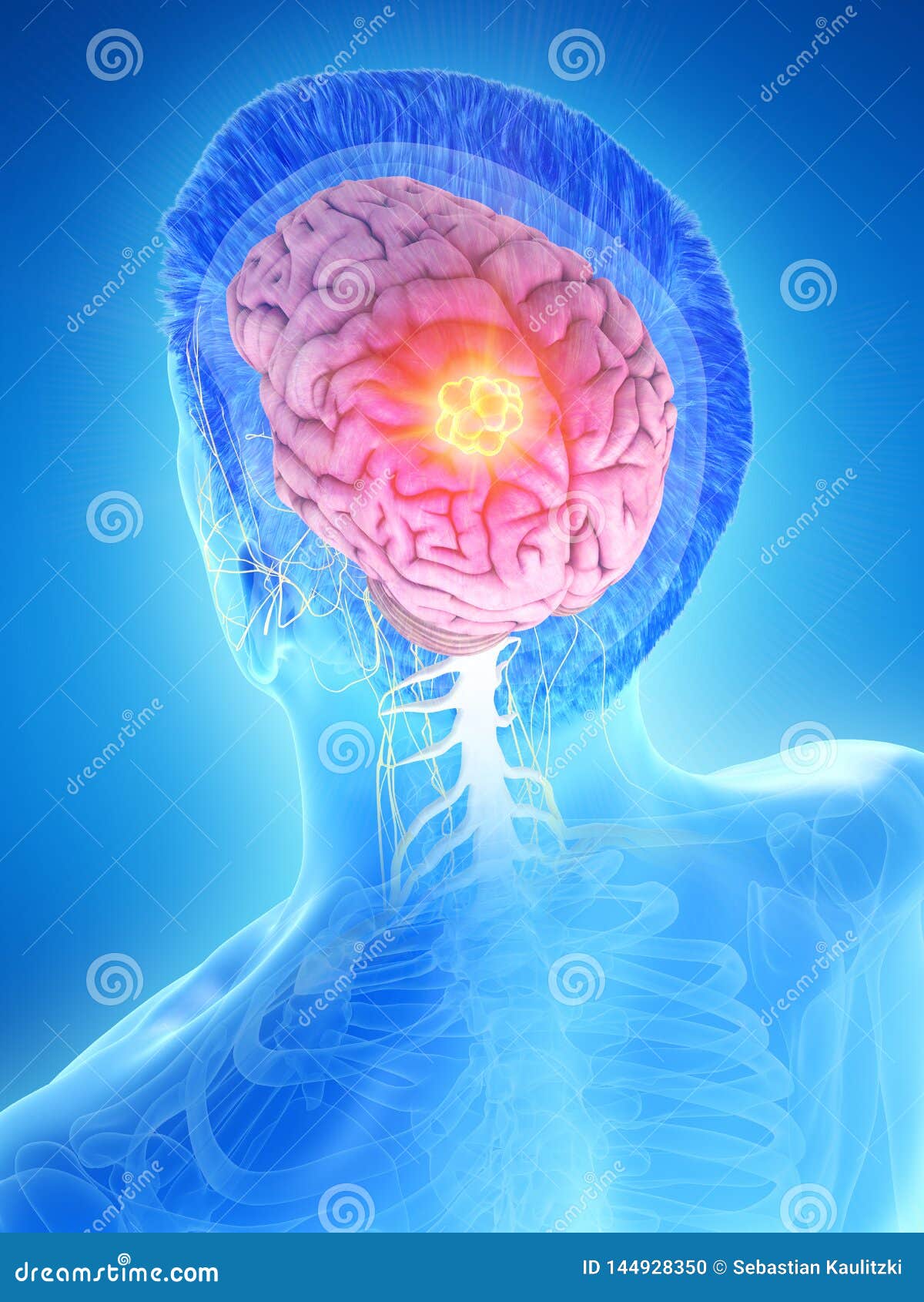 A mans brain tumor stock illustration. Illustration of metastasis ...