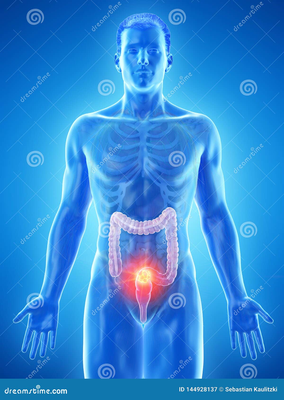 A Mans Colon Tumor Stock Illustration Illustration Of Inflammatory