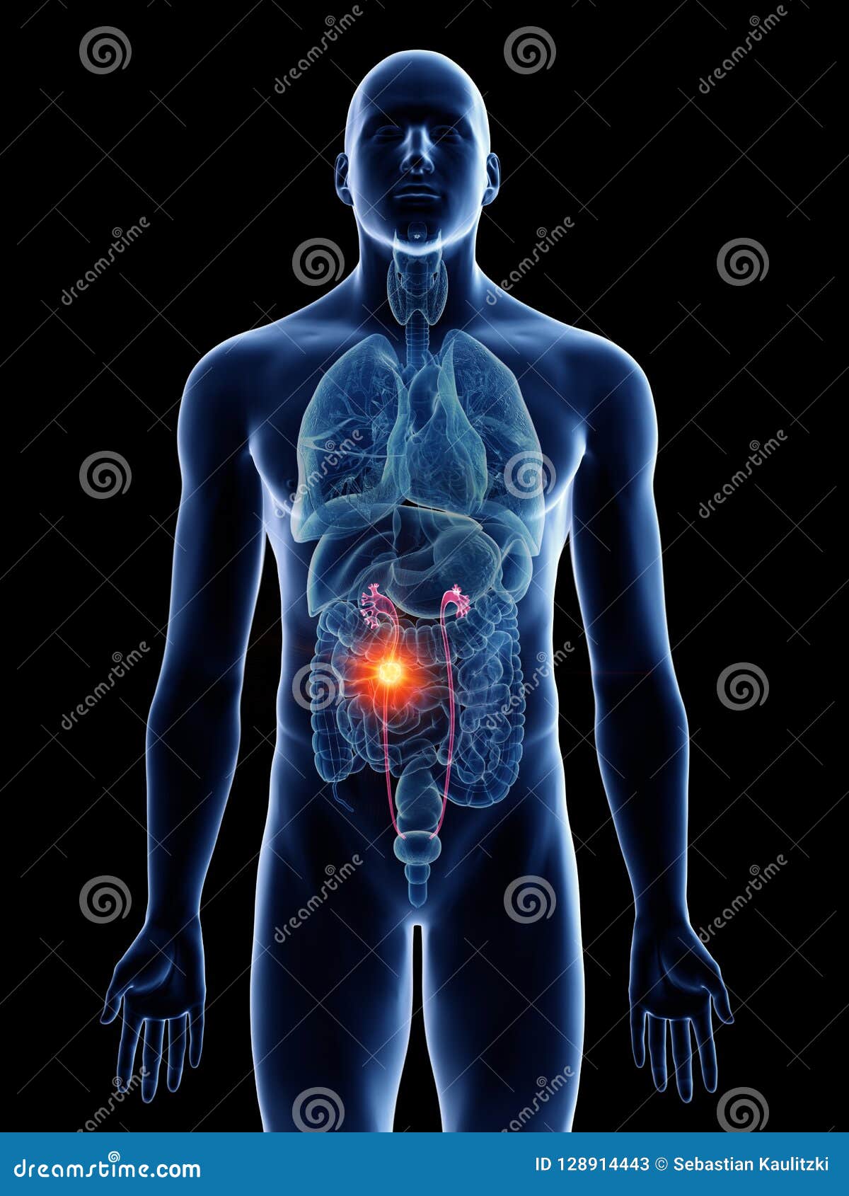 A Tumor Of The Ureter. Hydronephrosis. Setting Of Nephrostomy Tube ...