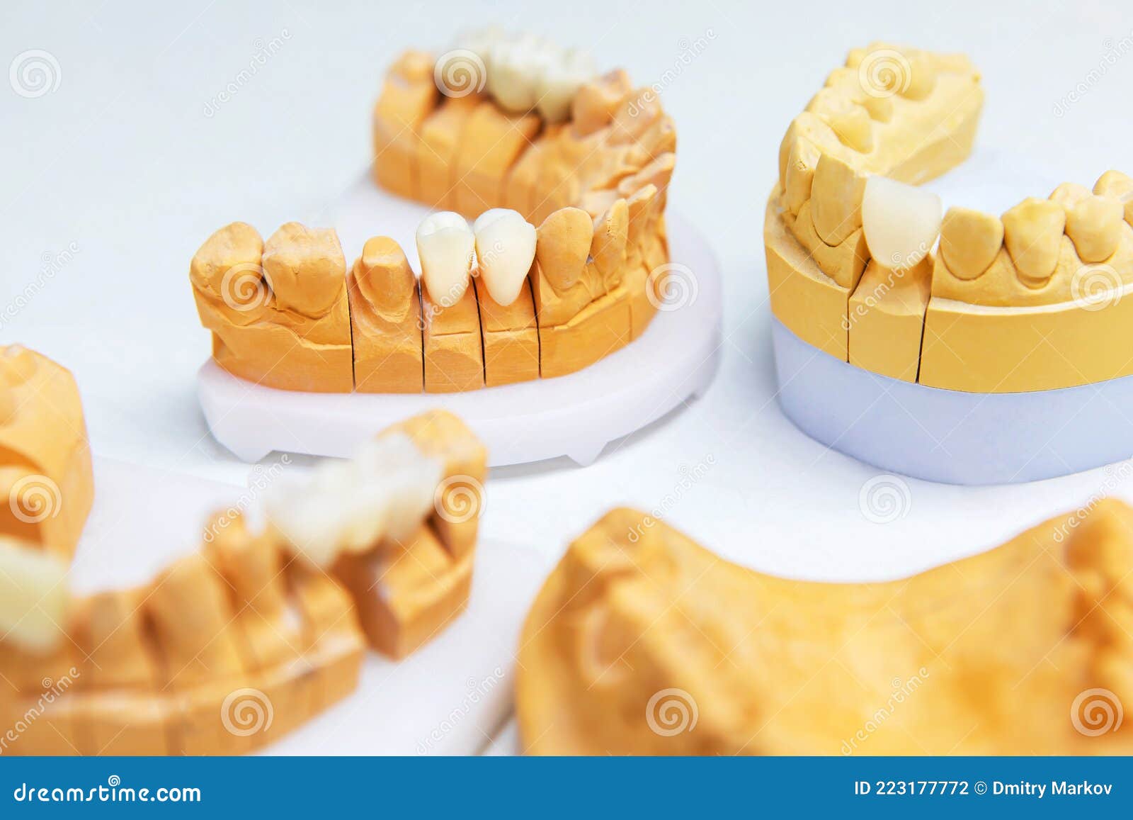 Manufacturing of Dental Implants. Artificial Teeth on the Jaw Layout ...