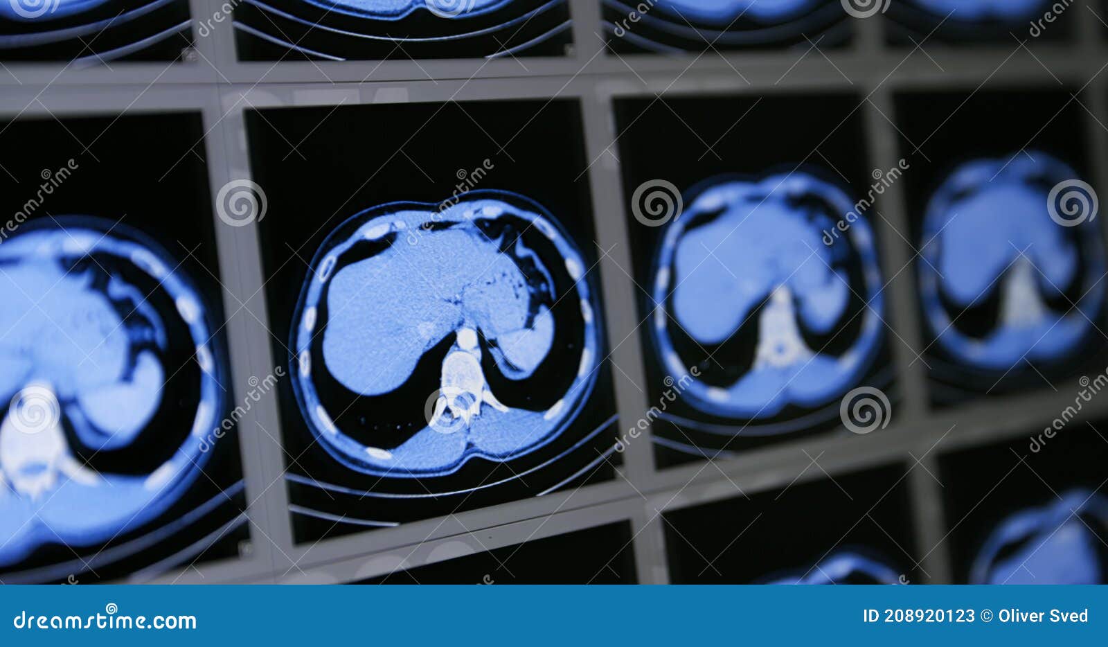 Many Computed Tomography Scans in Motion of Lower and Middle Abdominal ...