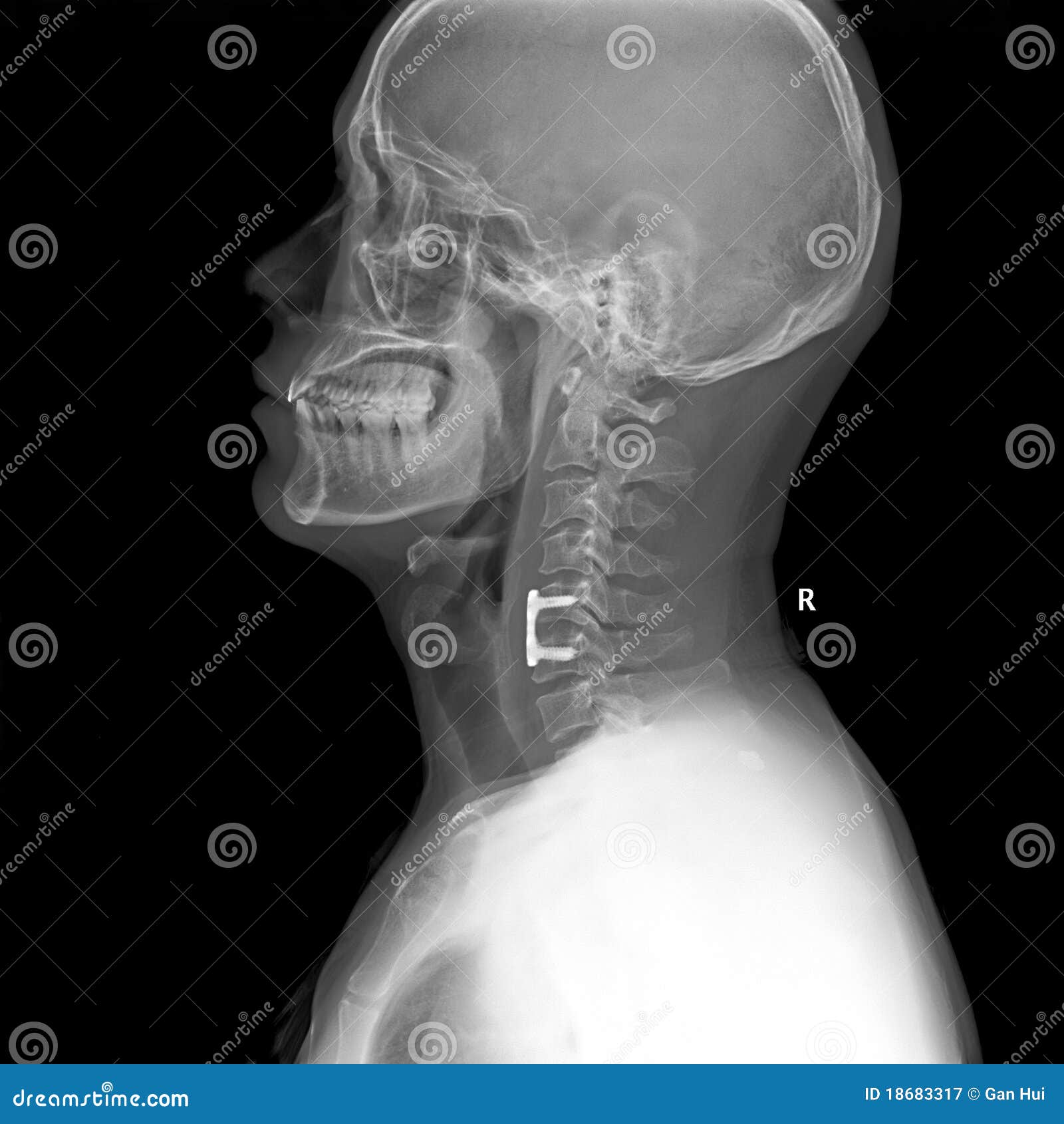 Maschera Laterale Dei Raggi X Della Testa E Del Collo Immagine Stock ...
