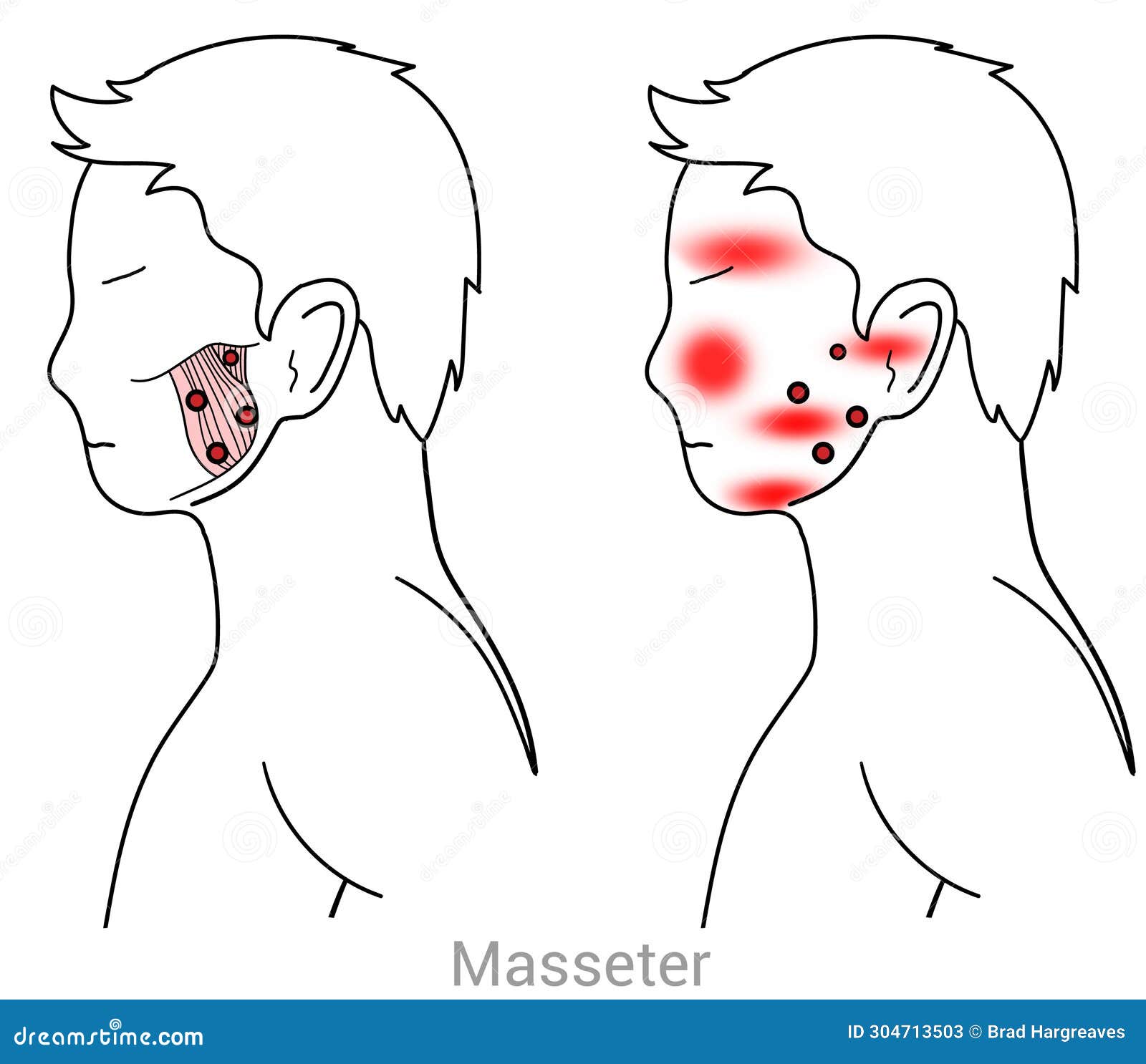 Masseter stock illustration. Illustration of teeth, ache - 304713503