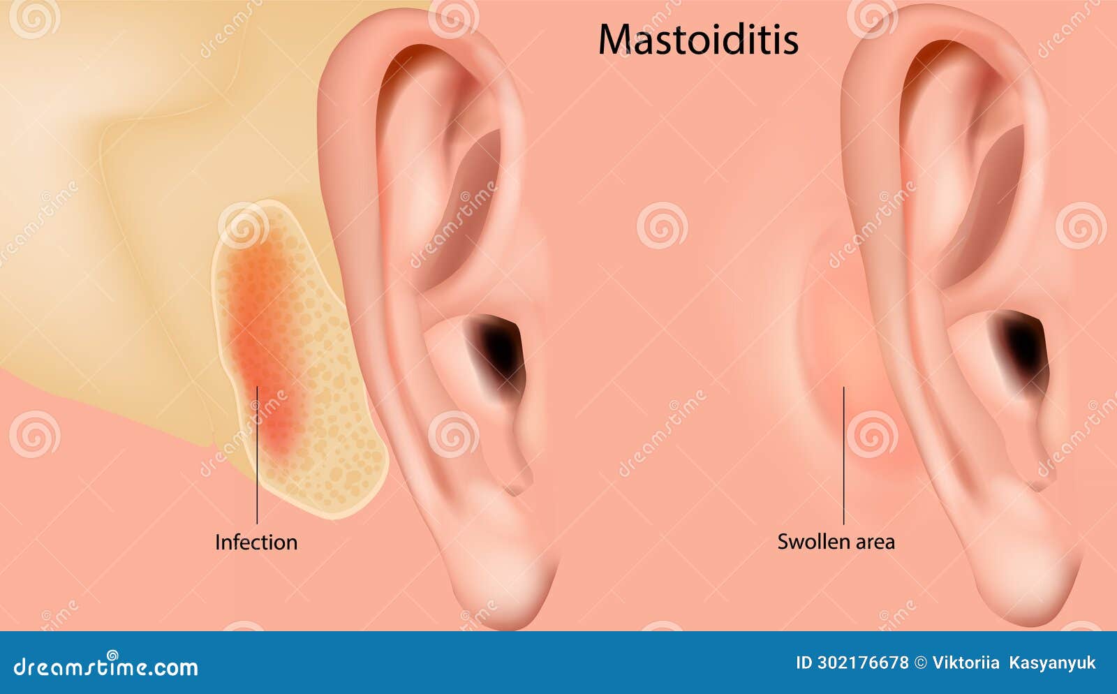 Mastoiditis. Inflammation of the Mucosal Lining of the Mastoid Antrum and Mastoid Air Cell ...