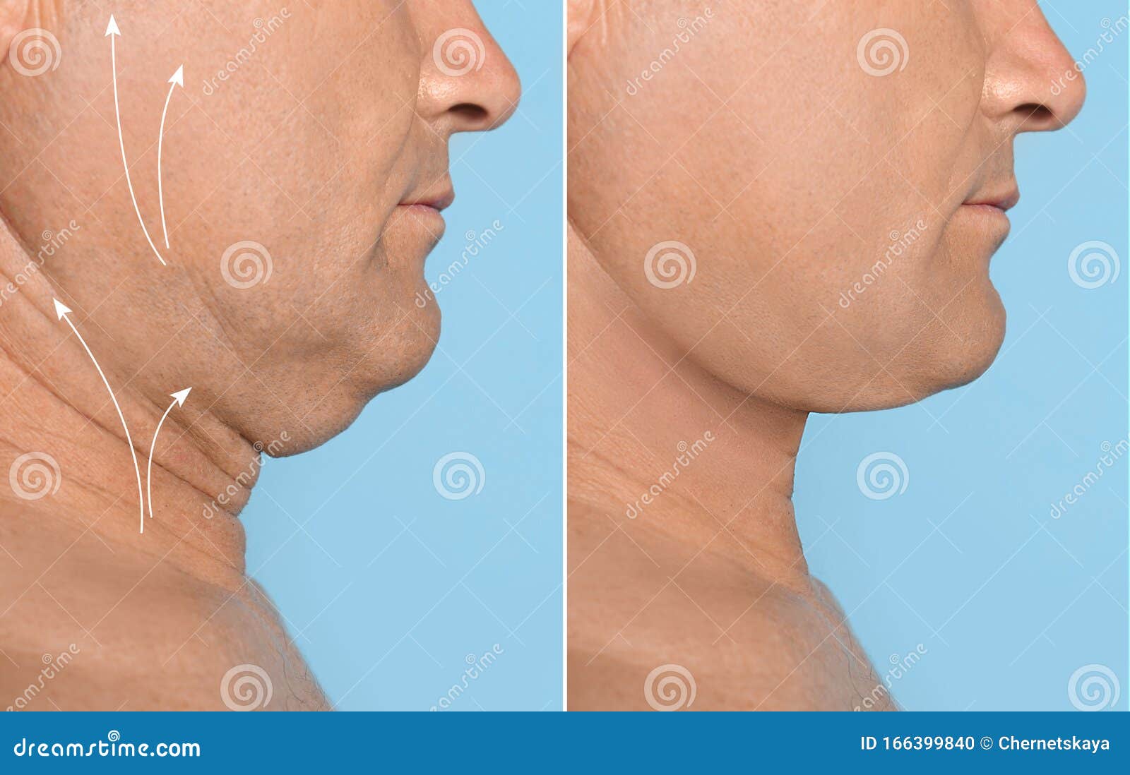 Mature Man before and after Surgery Operation on Blue Background ...