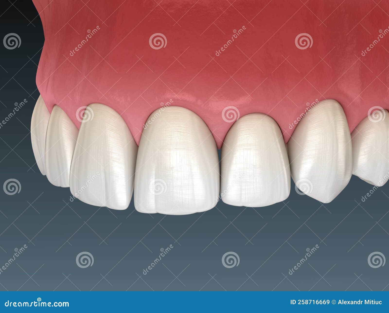 Maxillary Human Gum and Teeth. Stock Illustration - Illustration of ...