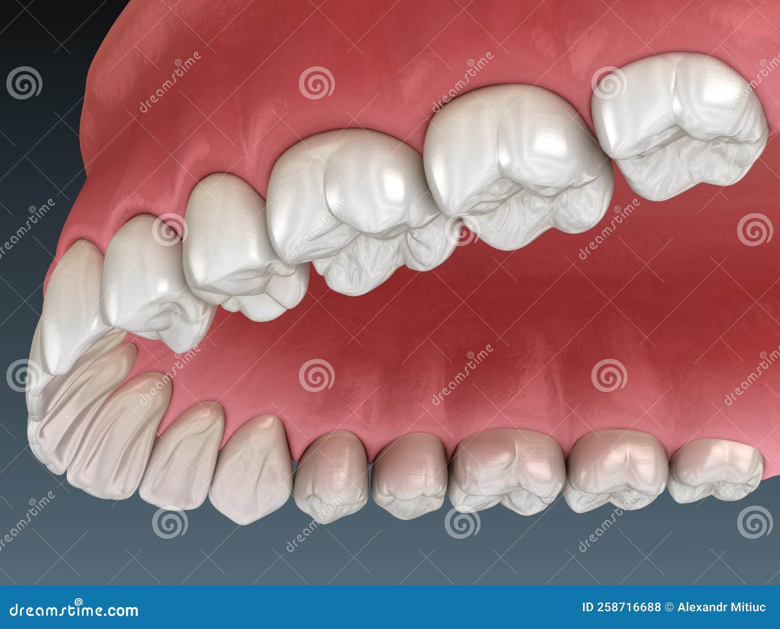 Maxillary Human Gum and Teeth. Stock Illustration - Illustration of ...