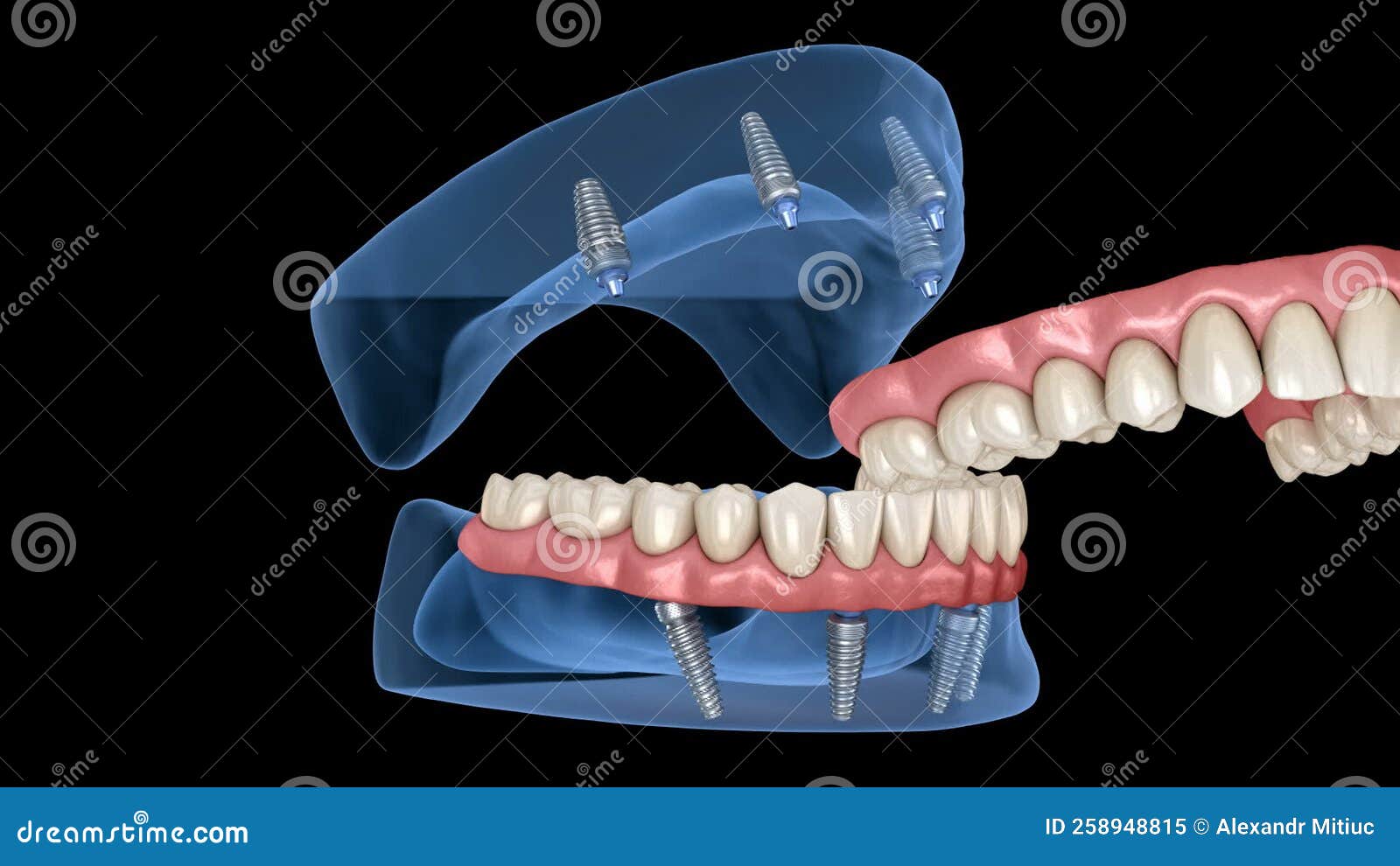 Maxillary and Mandibular Prosthesis with Gum All on 4 System Supported ...