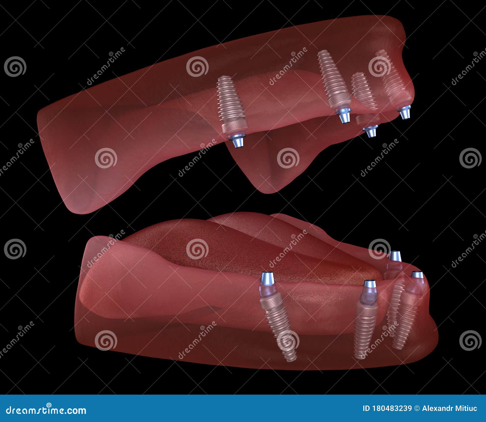 maxillary and mandibular prosthesis with gum all on 4 system supported ...