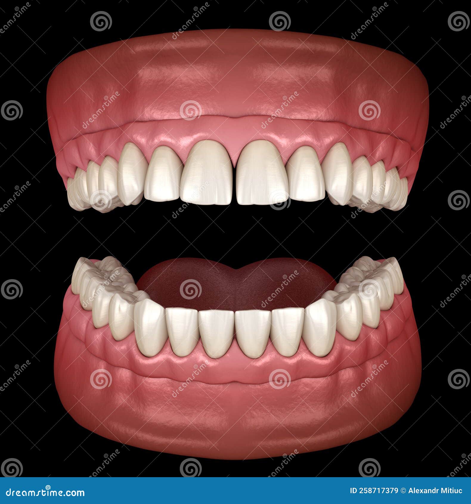 Maxillary and Mandibular Prosthesis with Gum All on 4 System Supported ...