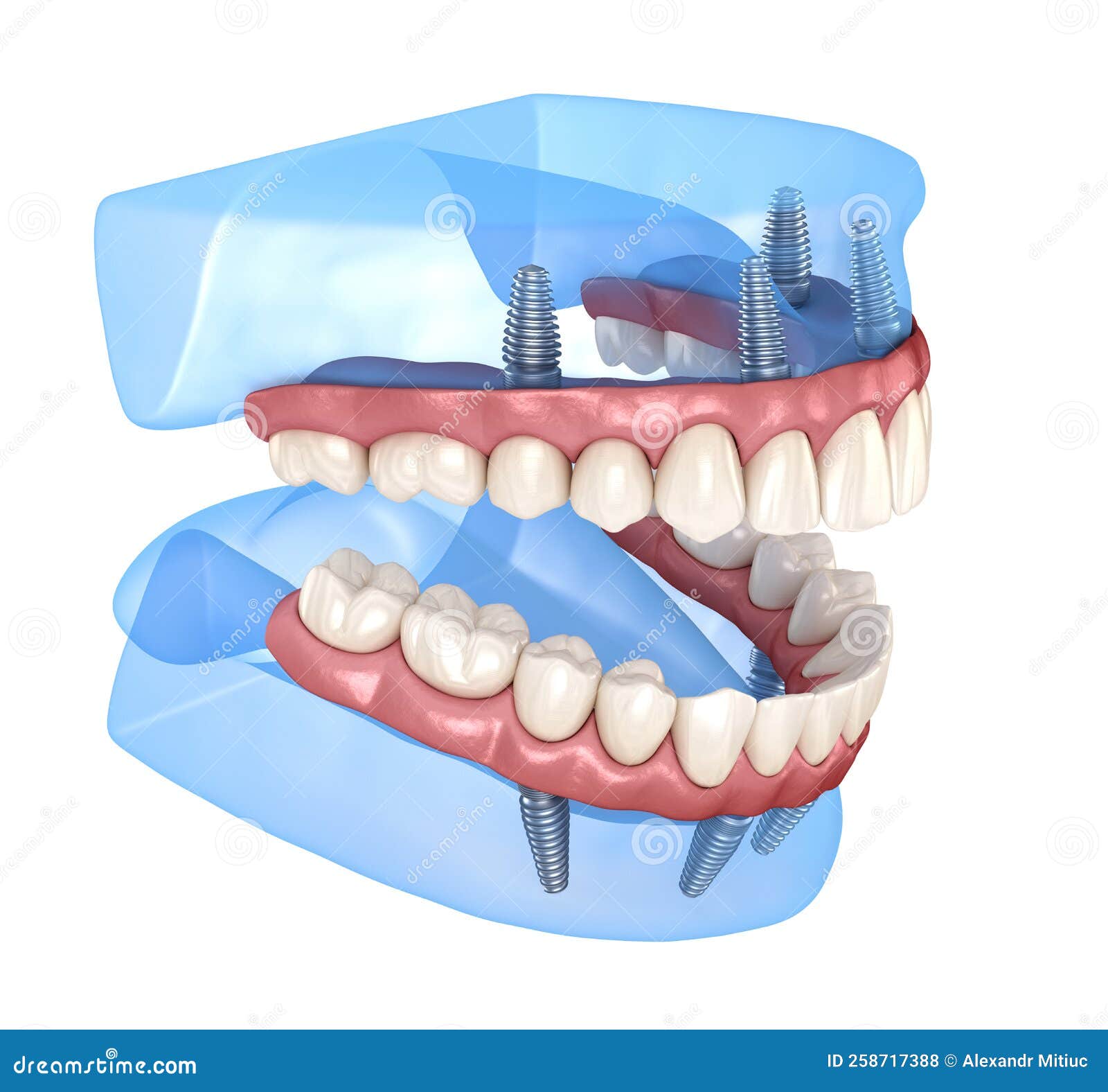 Maxillary and Mandibular Prosthesis with Gum All on 4 System Supported ...