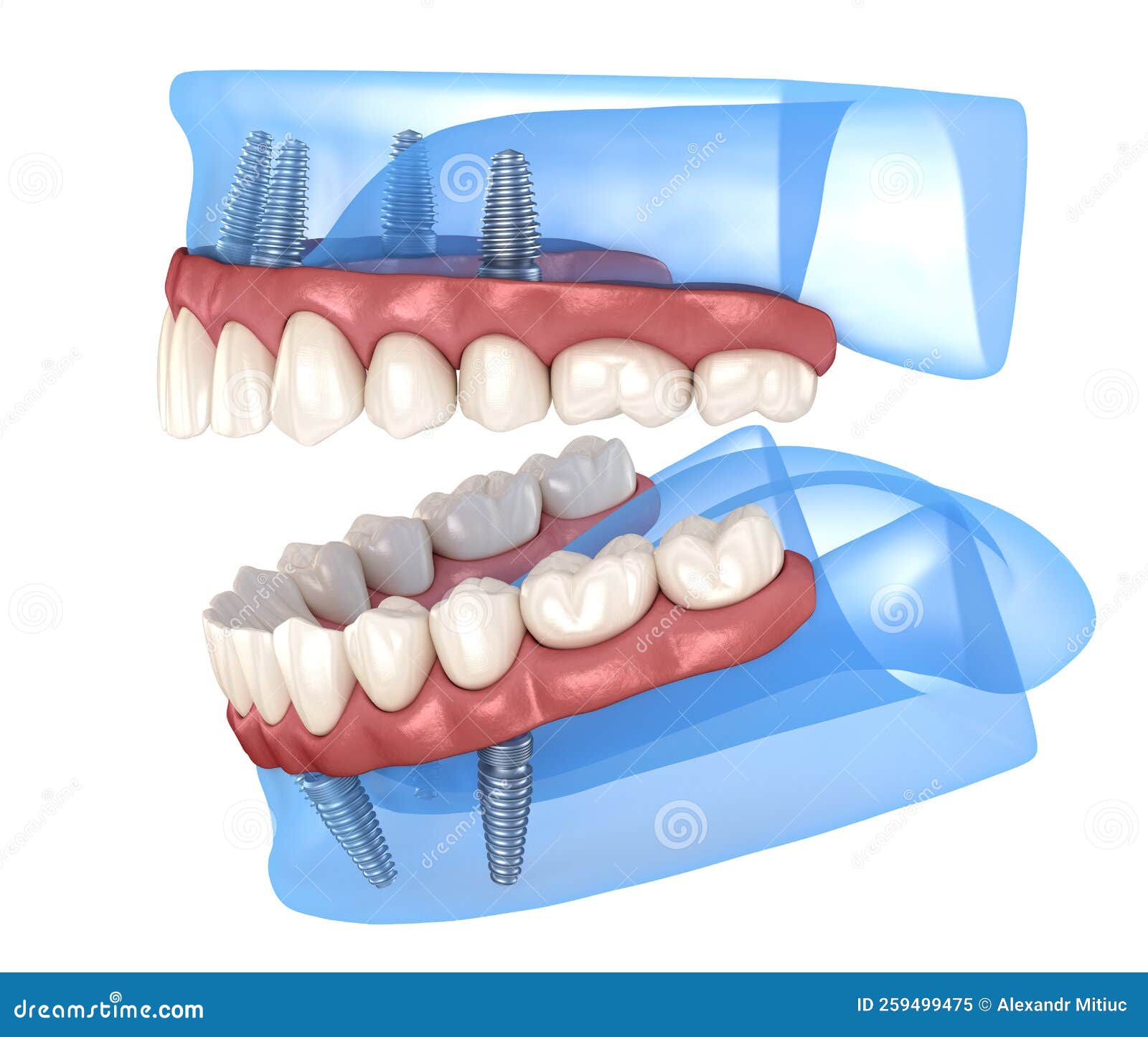 Maxillary and Mandibular Prosthesis with Gum All on 4 System Supported ...