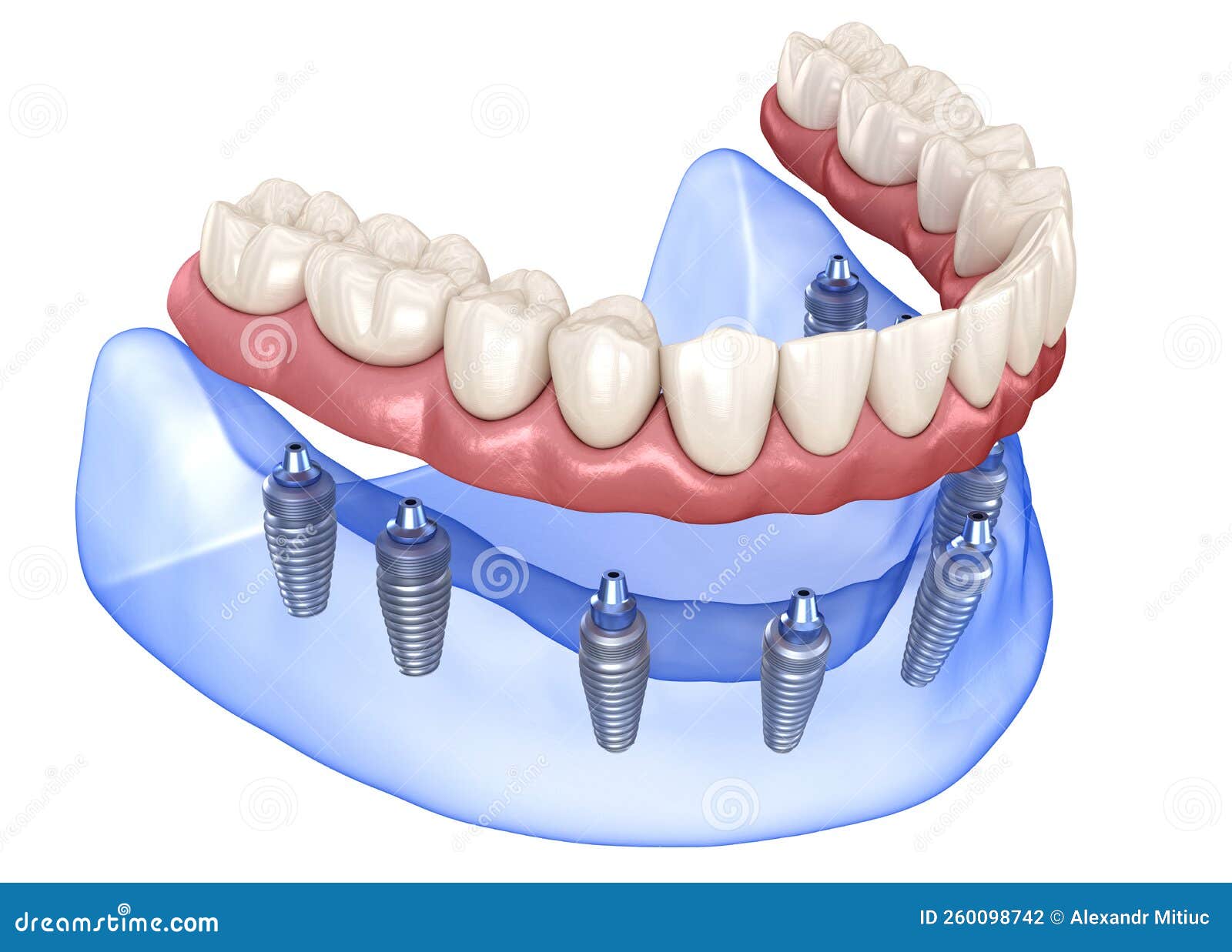 Maxillary and Mandibular Prosthesis with Gum All on 8 System Supported ...