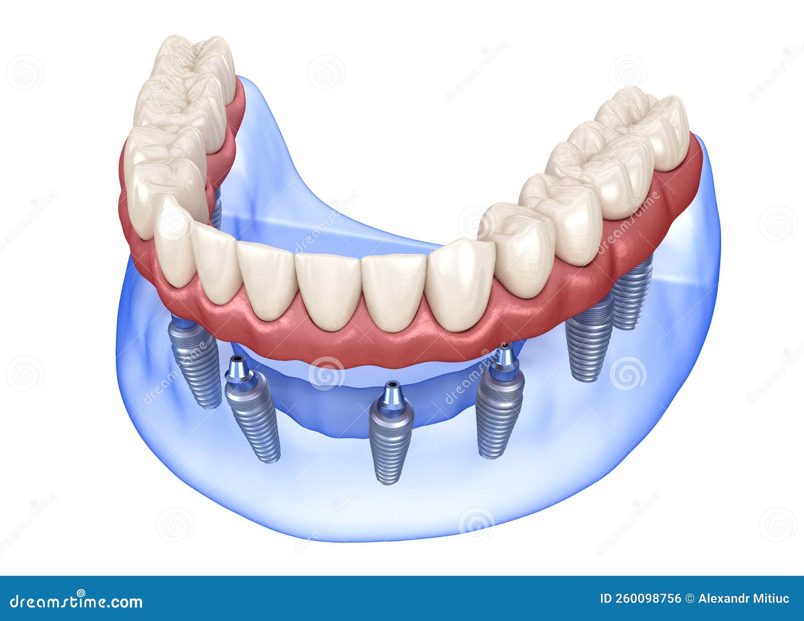 Maxillary and Mandibular Prosthesis with Gum All on 8 System Supported ...