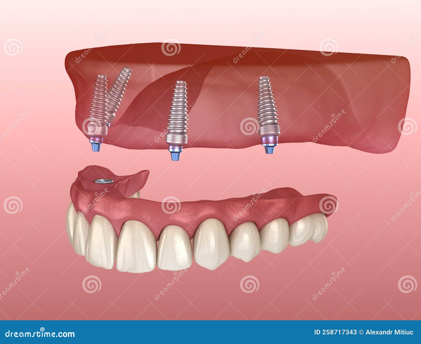 Maxillary Prosthesis with Gum All on 4 System Supported by Implants ...