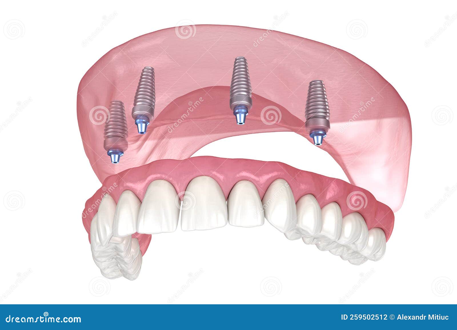 Maxillary Prosthesis with Gum All on 4 System Supported by Implants ...