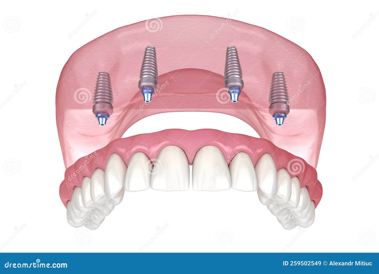 Maxillary Prosthesis with Gum All on 4 System Supported by Implants ...