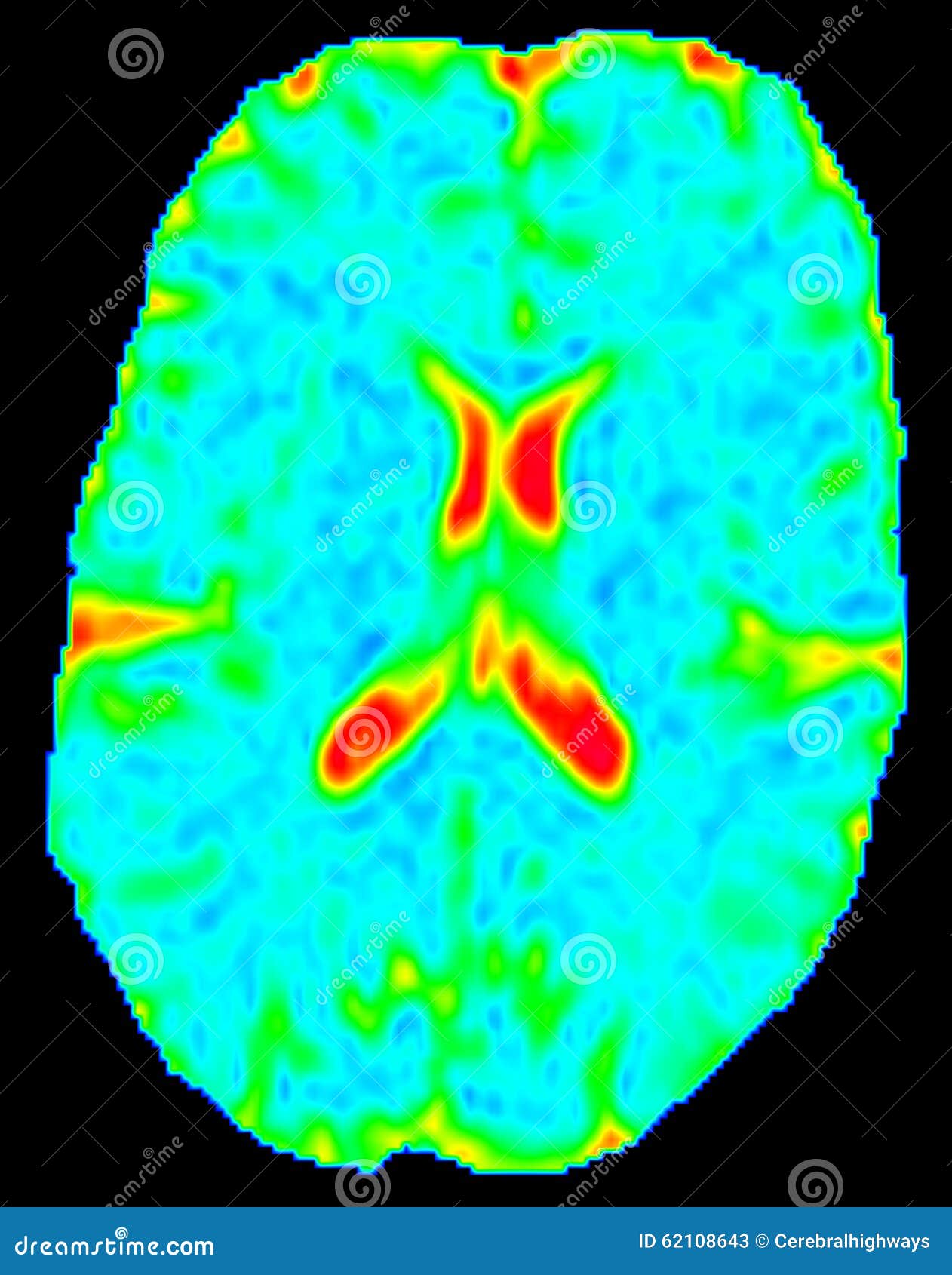 Mean Diffusivity Brain Map in Axial View Stock Image - Image of ...