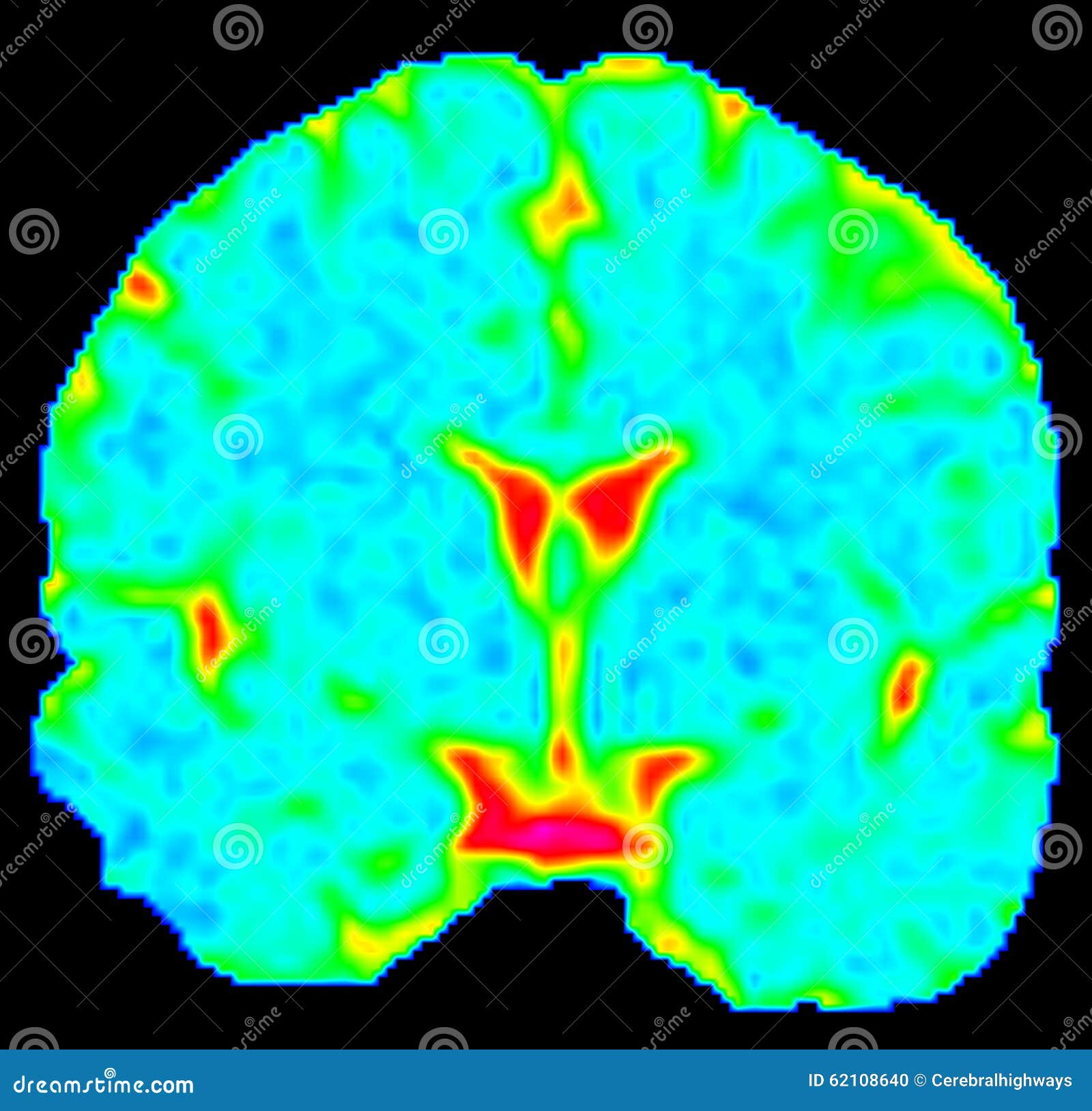 MRA Brain Coronal 3D Sagittal MIP View Showing Common Carotid Artery ...