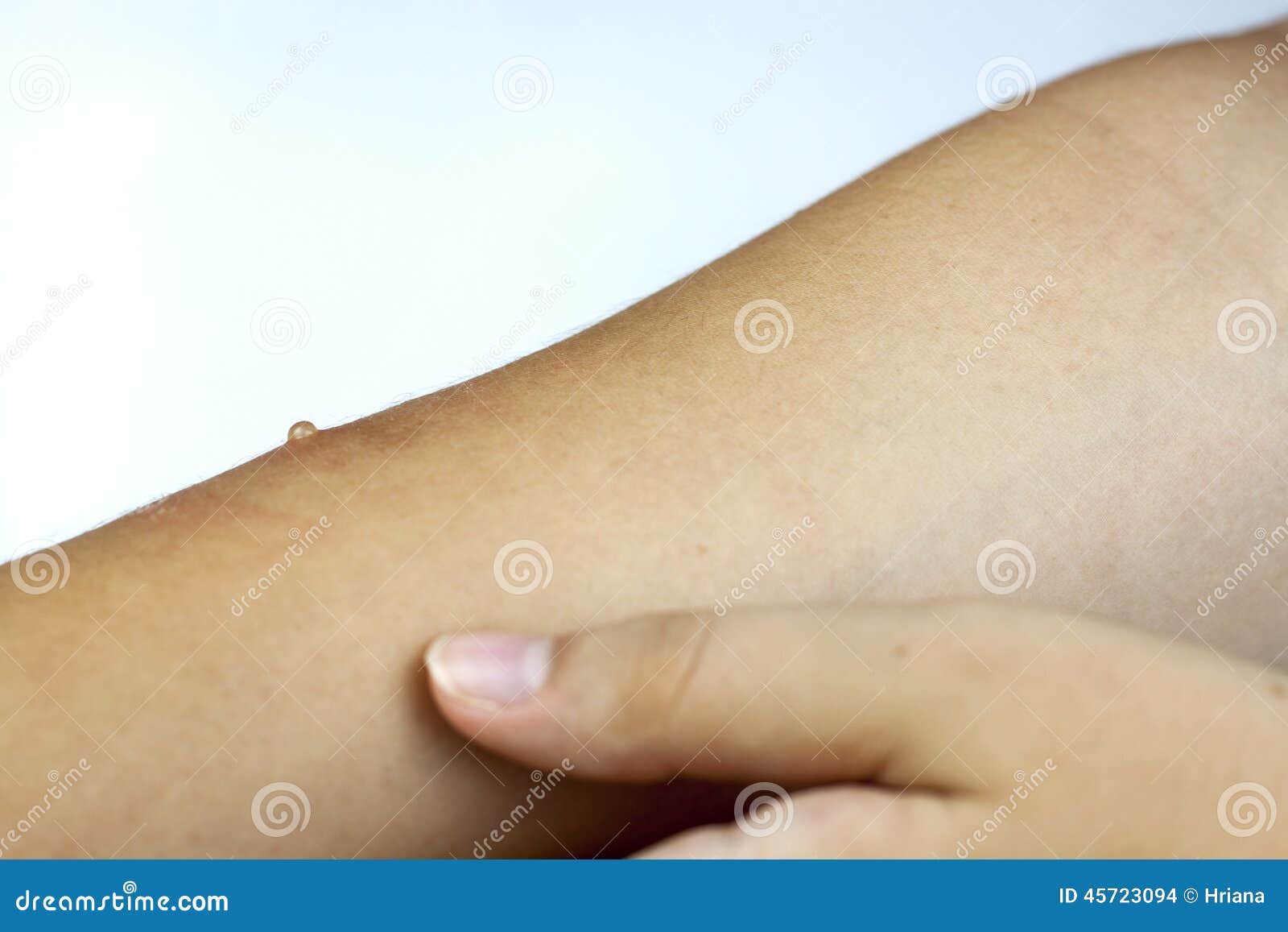 Measles on arm stock photo. Image of plague, disease - 45723094