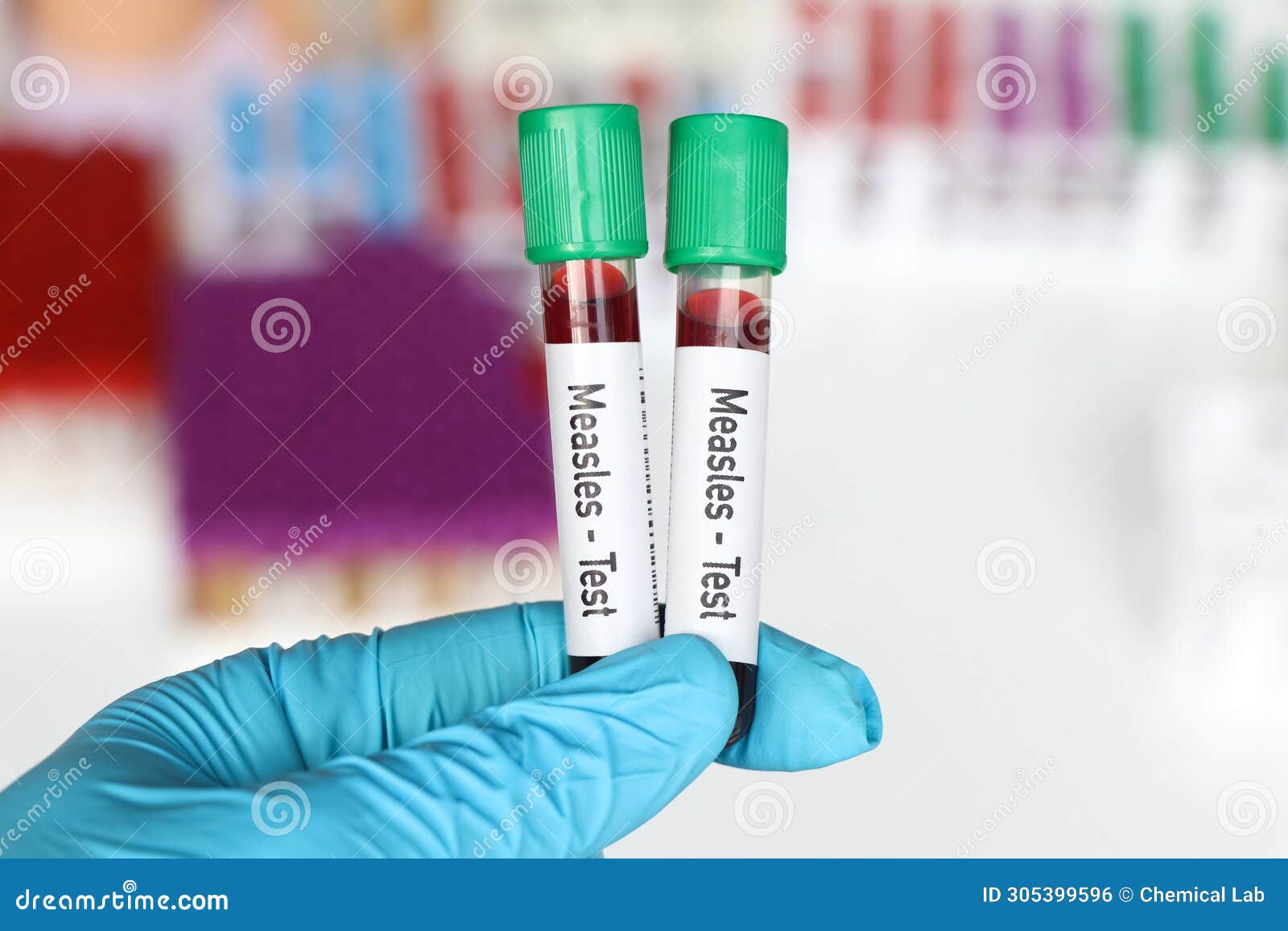 Measles Test, Blood Sample To Analyze in the Laboratory Stock Photo ...