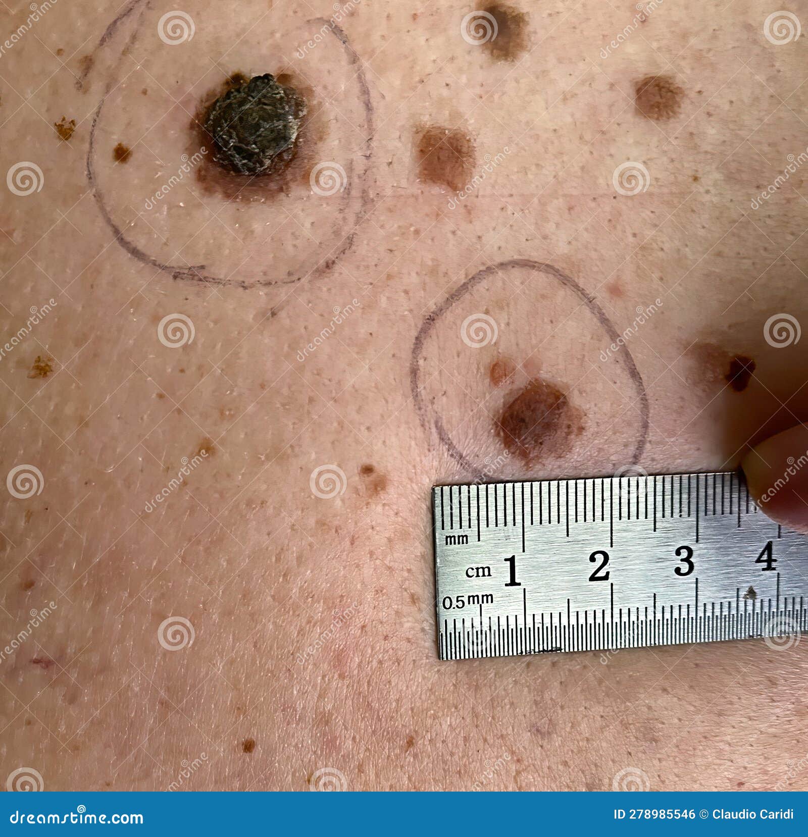 Measuring the Size of a Mole on Human Skin Stock Photo - Image of ...