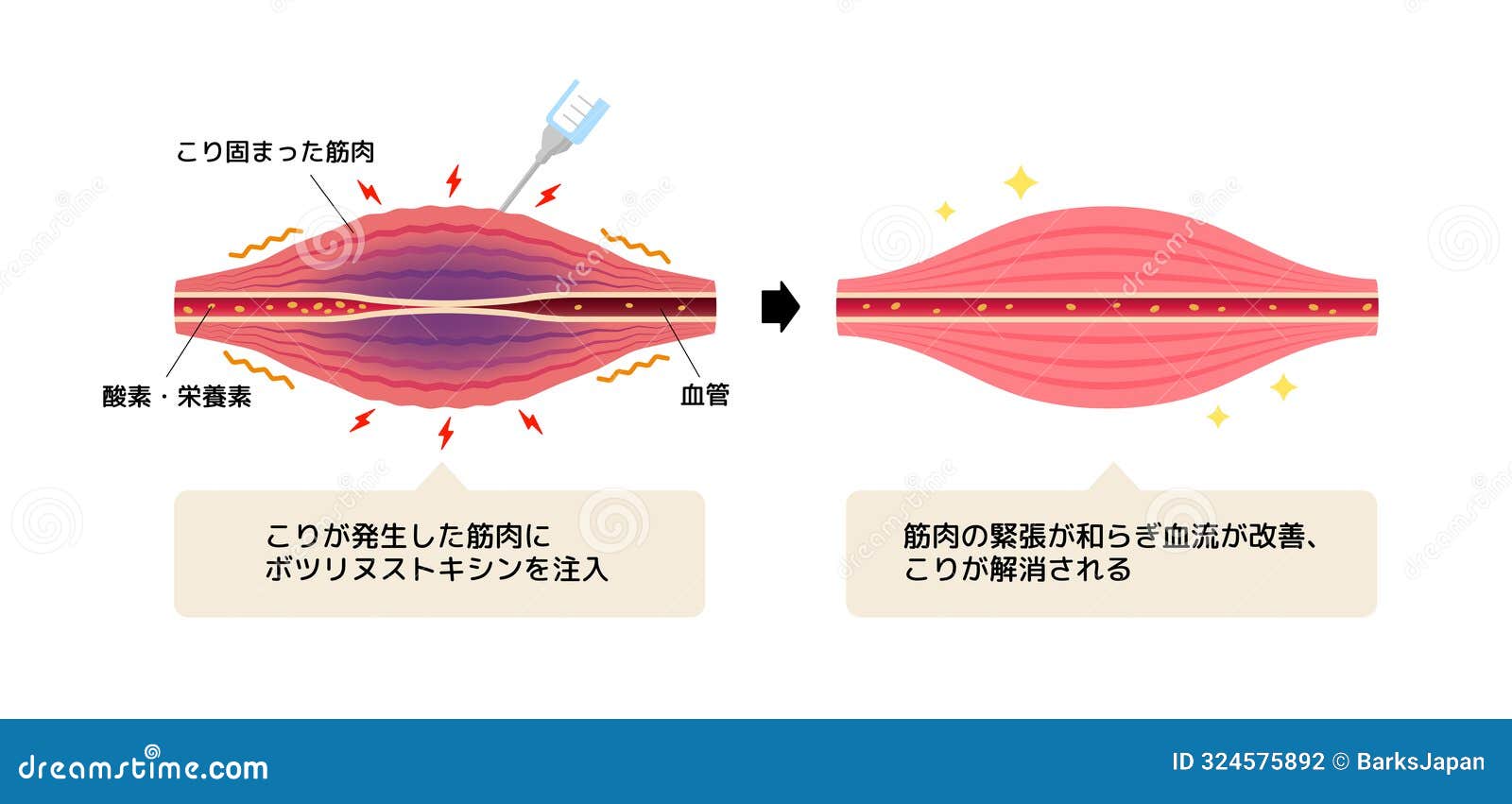 Mechanism Of Muscle Relaxation By Botulinum Toxin Injection Vector ...