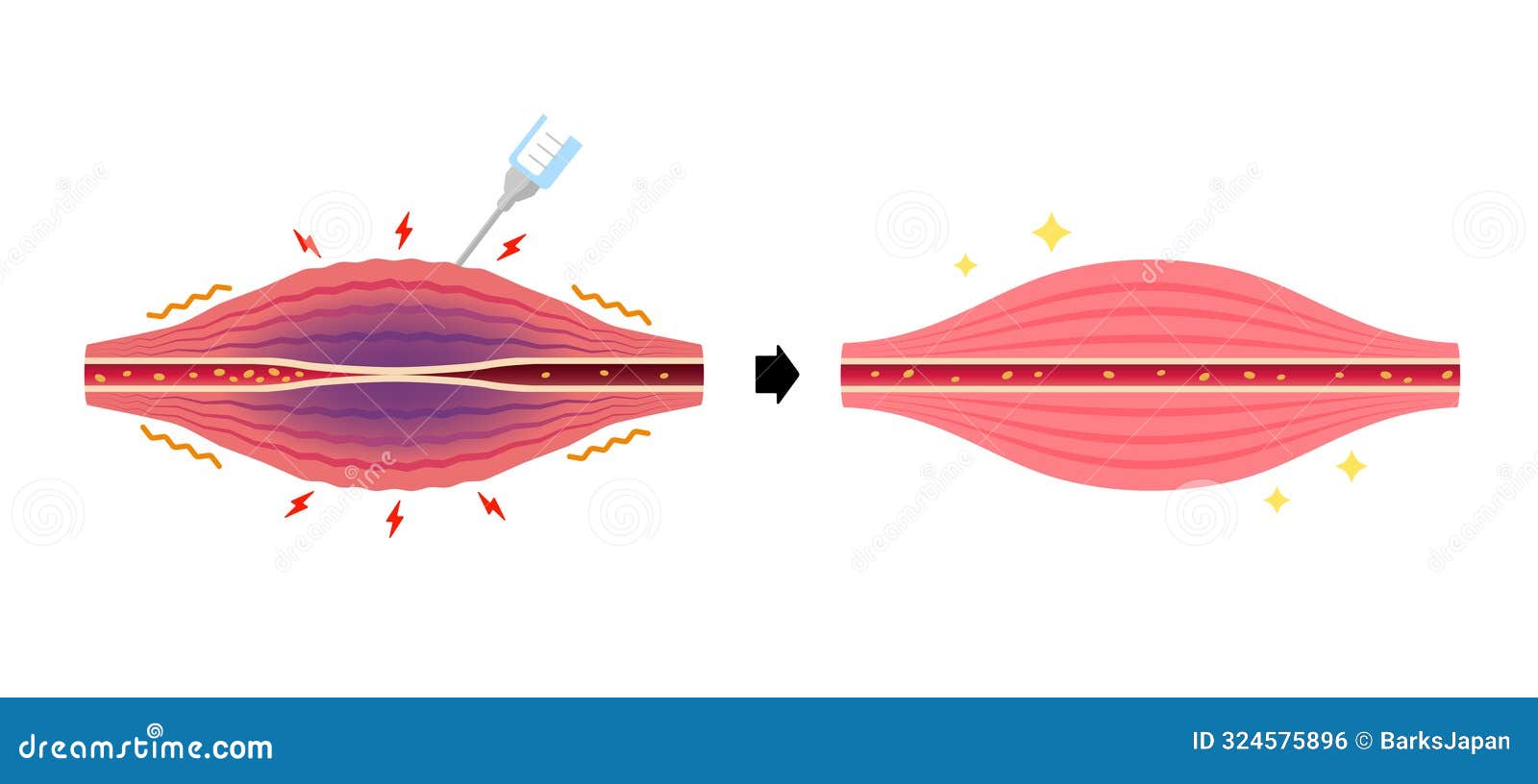 Mechanism of Muscle Relaxation by Botulinum Toxin Injection Stock ...
