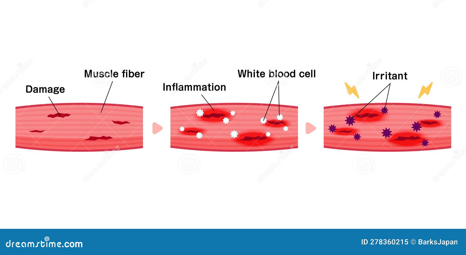 Mechanism Of ACL Injury As Knee Trauma Anatomical Explanation Outline ...