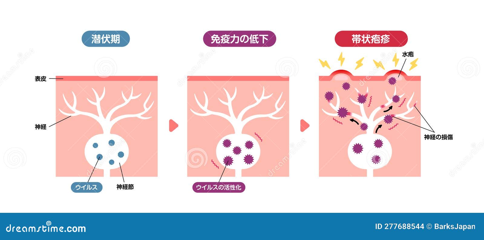 Mechanism of Shingles ( Herpes Zoster ) Vector Illustration Stock ...