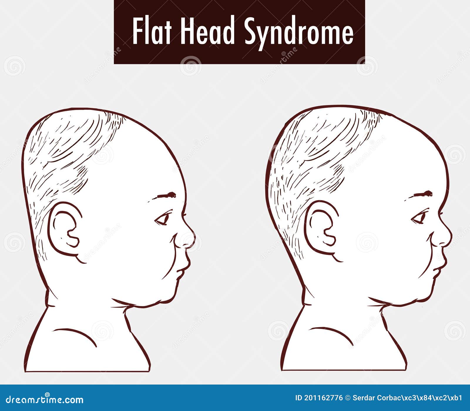 Mechanisms of Head Injury Vector Illustration Stock Vector ...